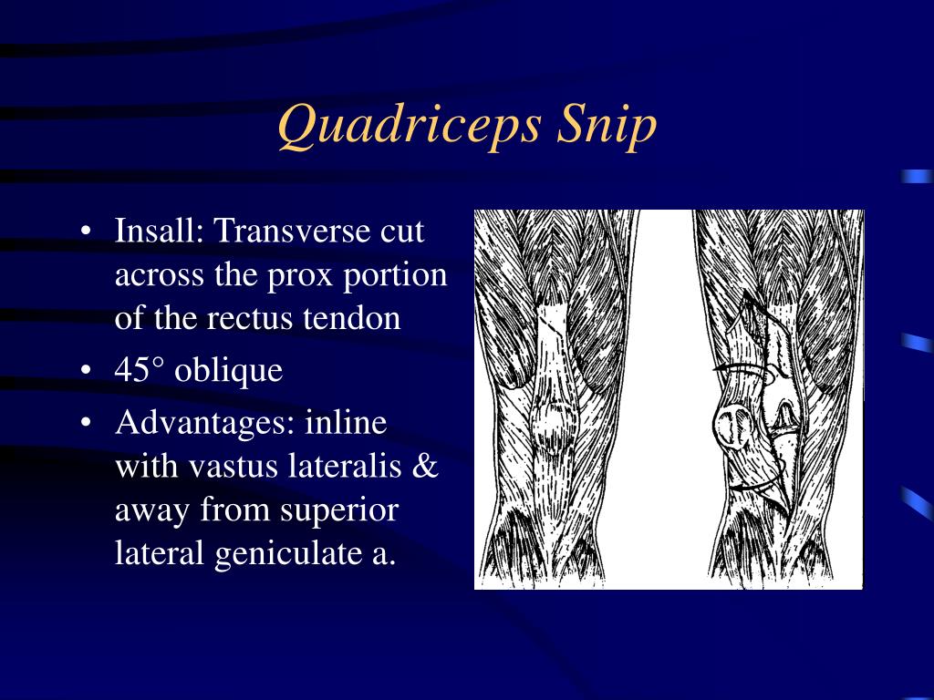 PPT - Surgical Approaches In Total Knee Arthroplasty PowerPoint ...