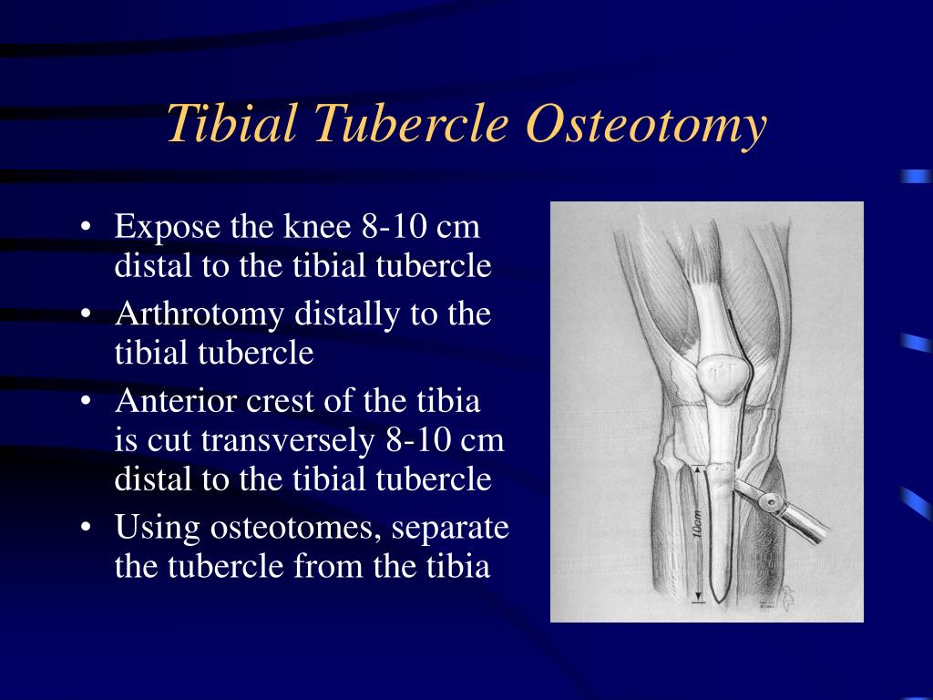 PPT - Surgical Approaches In Total Knee Arthroplasty PowerPoint ...