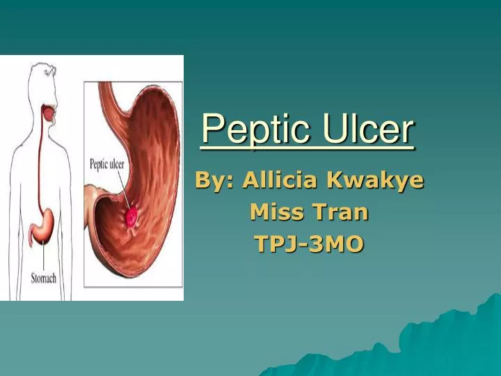 PPT - Peptic Ulcer PowerPoint Presentation, free download - ID:6648369