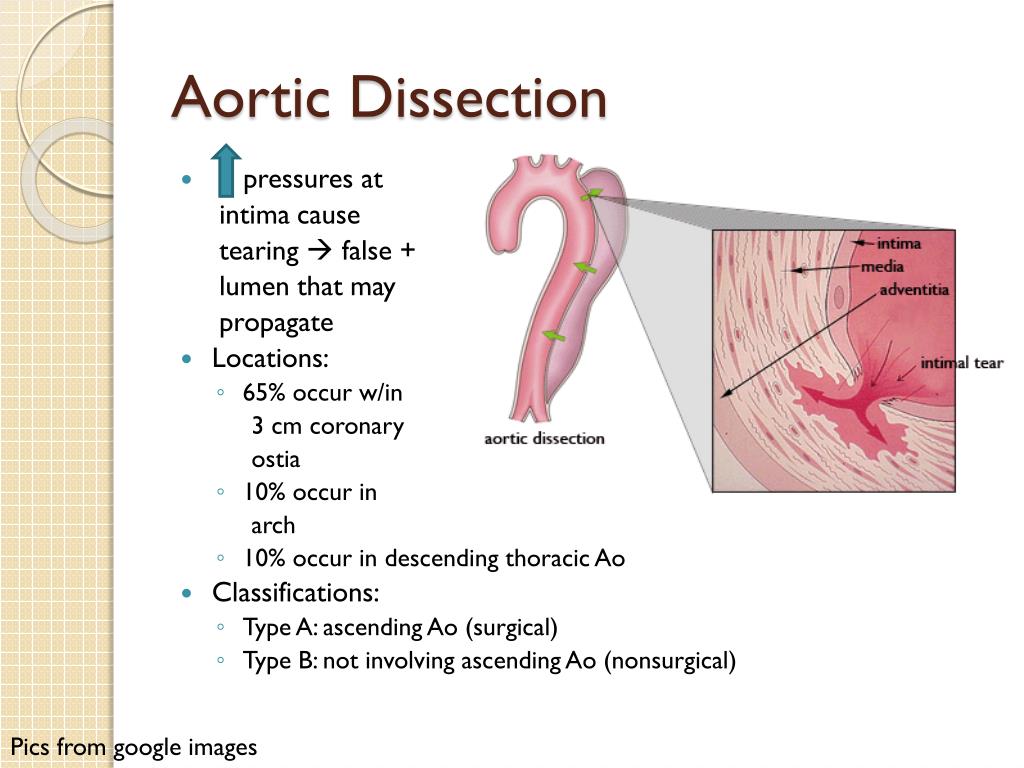 PPT - Echocardiographic Evaluation of Acute Aortic Syndromes PowerPoint ...
