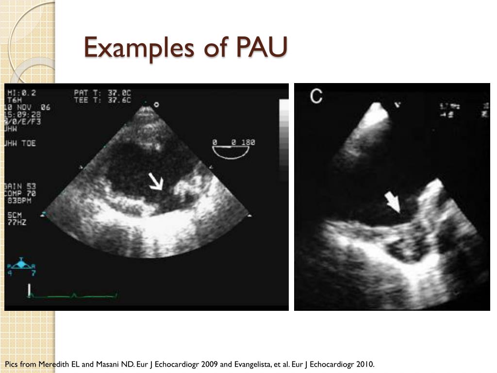 PPT - Echocardiographic Evaluation of Acute Aortic Syndromes PowerPoint ...