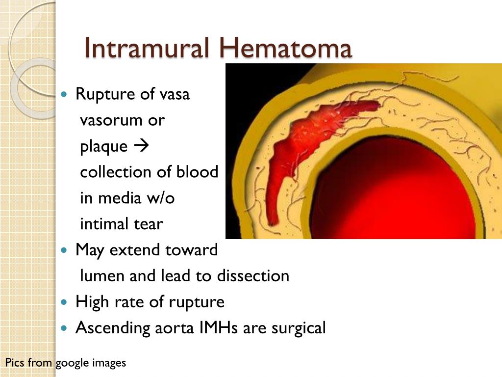 PPT - Echocardiographic Evaluation of Acute Aortic Syndromes PowerPoint ...