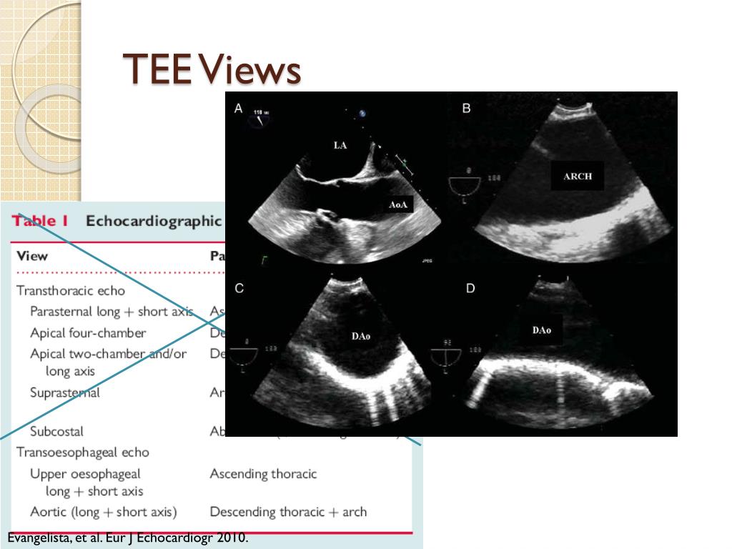 PPT - Echocardiographic Evaluation of Acute Aortic Syndromes PowerPoint ...
