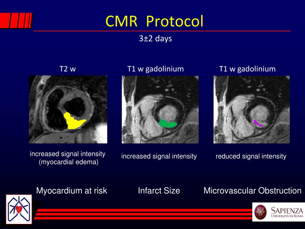 PPT - Impact Of Primary Coronary Angioplasty Delay PowerPoint ...