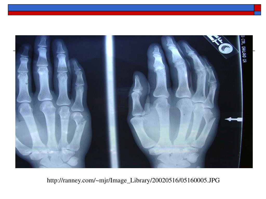 PPT - Wrist/Hand Anatomy PowerPoint Presentation, free download - ID ...