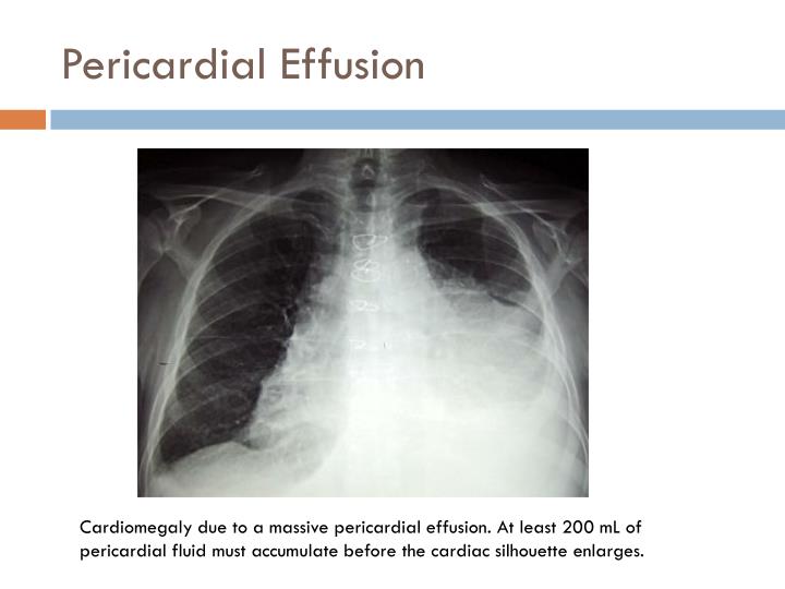 PPT - ACUTE PERICARDITIS PowerPoint Presentation - ID:6654087