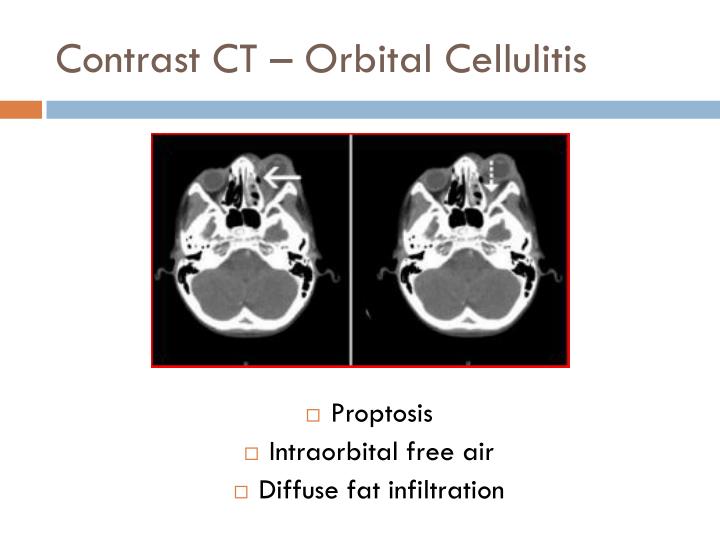 PPT - Periorbital vs Orbital Cellulitis PowerPoint Presentation - ID ...