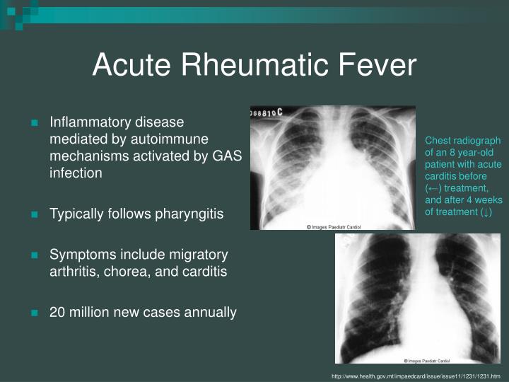 PPT - Streptococcus pyogenes PowerPoint Presentation - ID:6658249