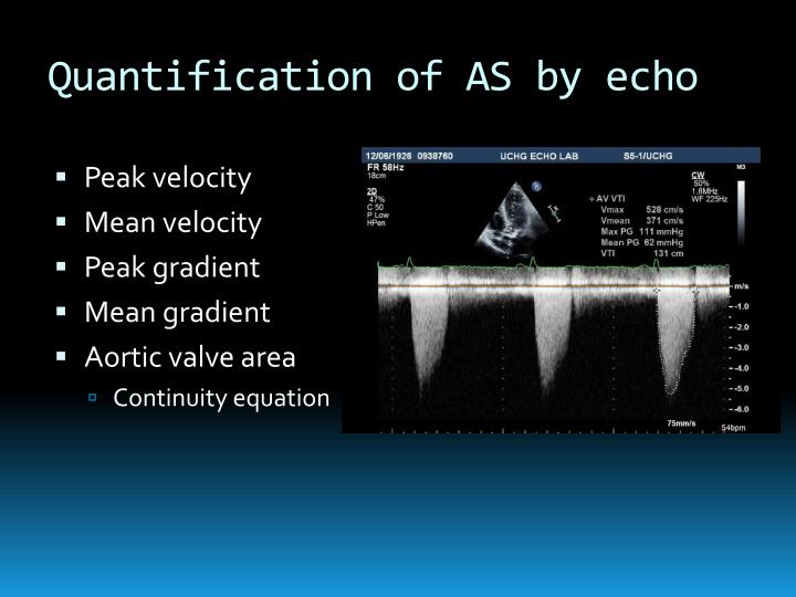 PPT - Aortic stenosis – when echo and cath (or even echo and echo) don ...