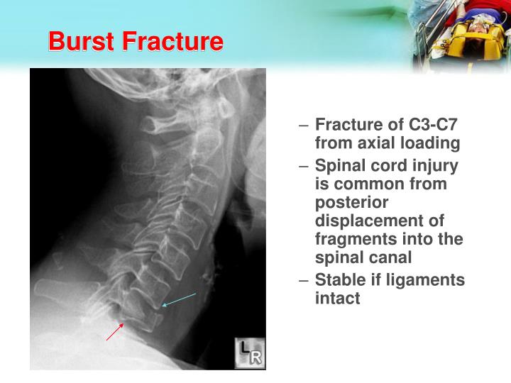 PPT - Spinal cord injury PowerPoint Presentation - ID:6662775
