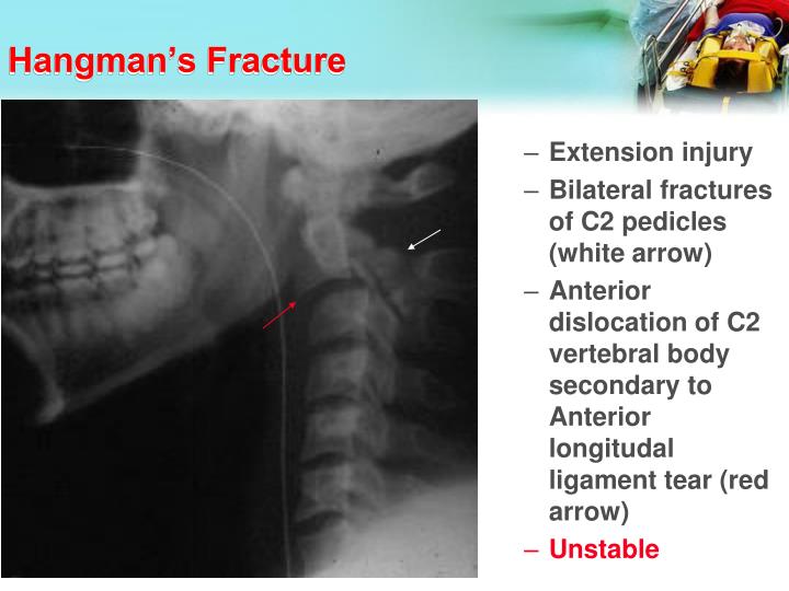 PPT - Spinal cord injury PowerPoint Presentation - ID:6662775