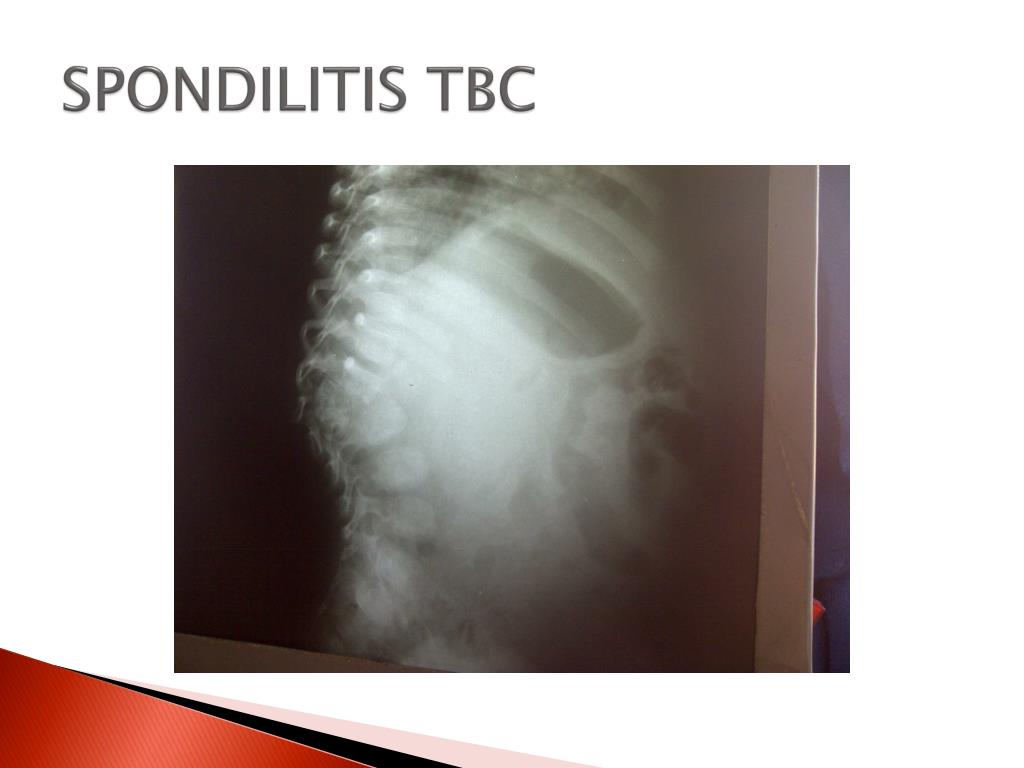 PPT - SPONDILITIS TUBERCULOSA (Potts desease ) PowerPoint Presentation ...