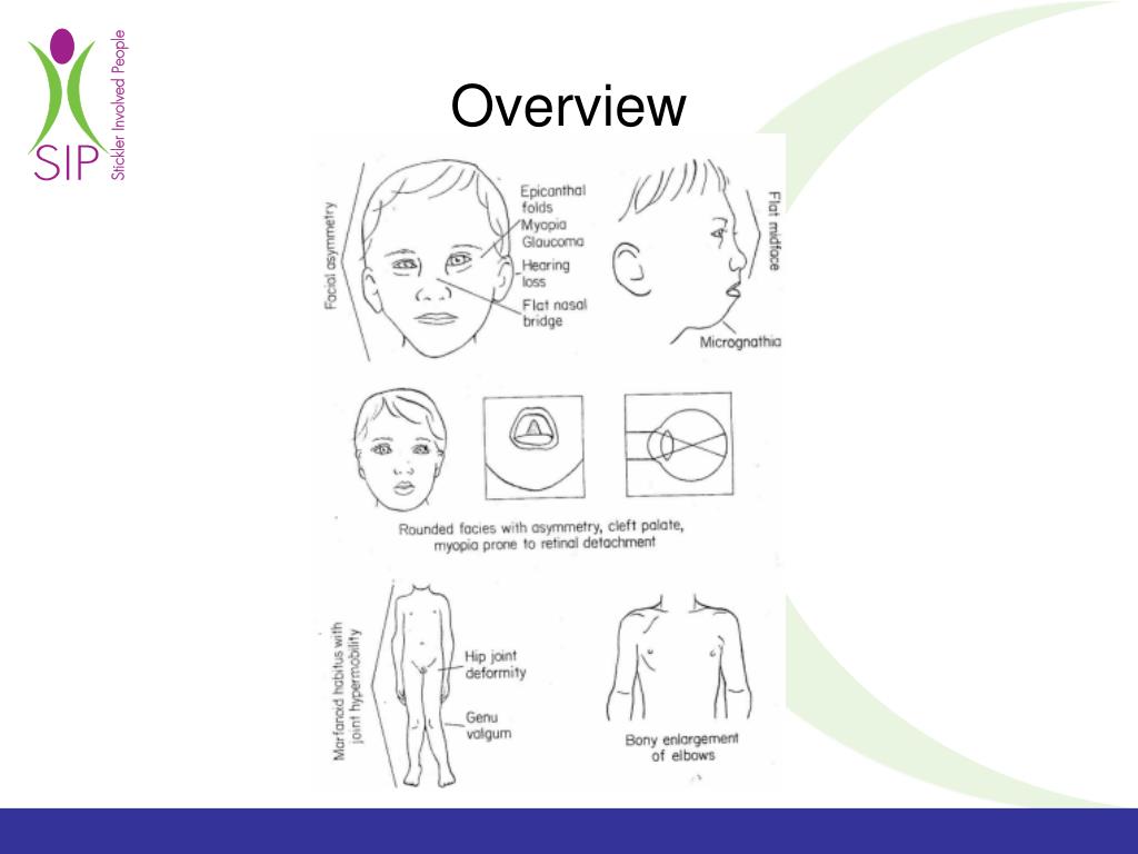 PPT - Stickler Syndrome: A Physician’s Overview PowerPoint Presentation ...
