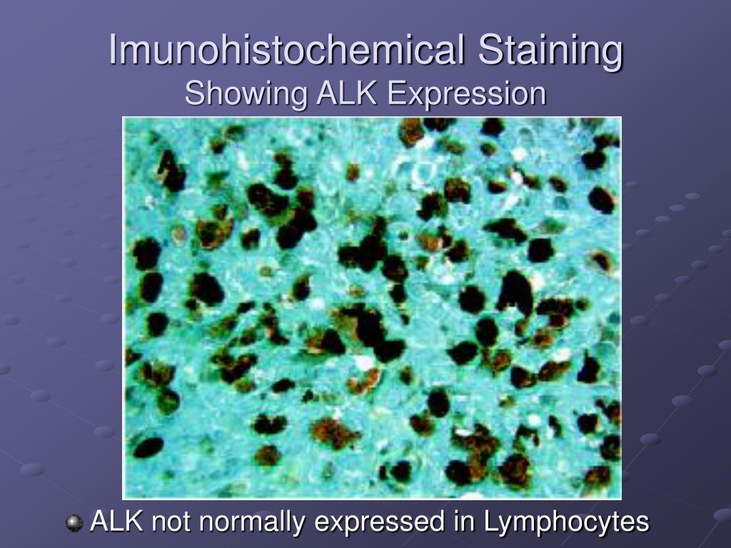 PPT - The Role of Alk in Anaplastic Large-cell Lymphoma (ALCL ...