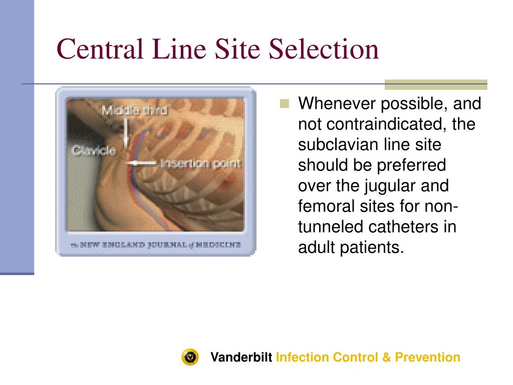 PPT - Central Line Associated Bloodstream Infections PowerPoint ...
