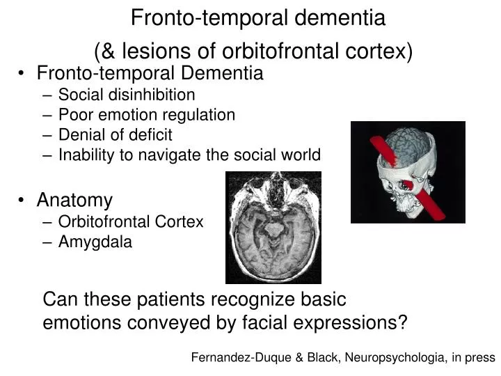 PPT - Fronto-temporal dementia (& lesions of orbitofrontal cortex ...