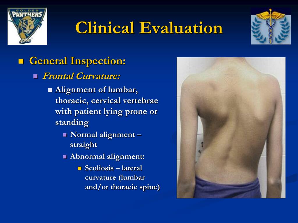 PPT - Thoracic and Lumbar Spine Clinical Evaluation PowerPoint ...