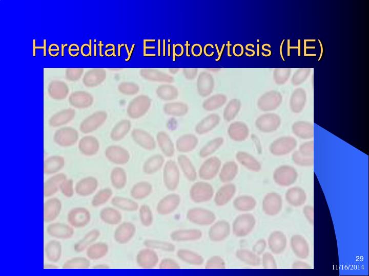 PPT - Hematology 425 Increased RBC Destruction, Intracorpuscular ...