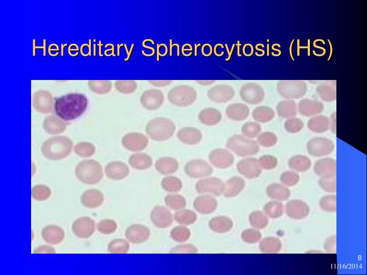 Spherocytosis Causes