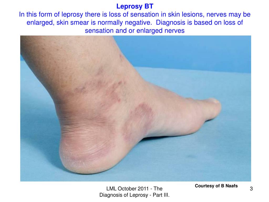 PPT - Diagnosis and the clinical spectrum of leprosy PowerPoint ...