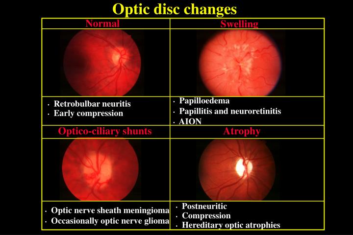 PPT - OPTIC NEUROPATHIES PowerPoint Presentation - ID:6690296