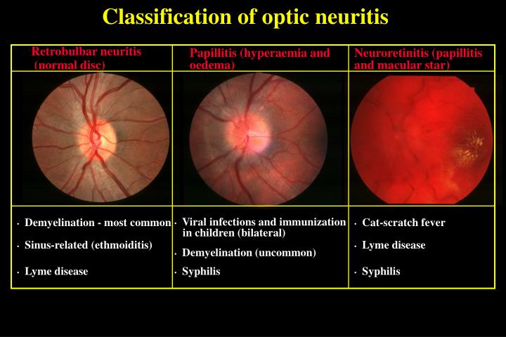 PPT - OPTIC NEUROPATHIES PowerPoint Presentation - ID:6690296