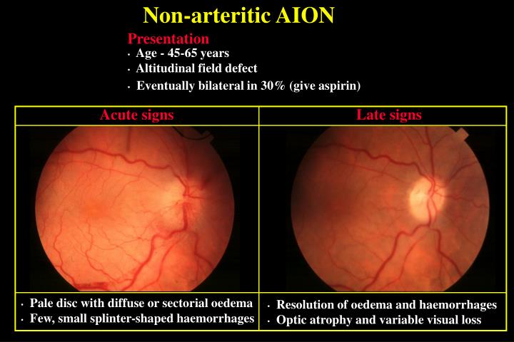 PPT - OPTIC NEUROPATHIES PowerPoint Presentation - ID:6690296