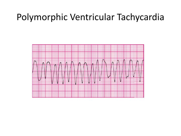 PPT - ACLS Rhythms Cheat Sheet PowerPoint Presentation - ID:6694546