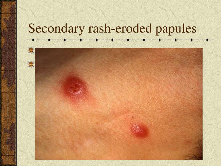 PPT - Syphilis: The New Epidemic PowerPoint Presentation - ID:6695251