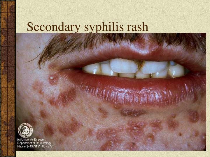 PPT - Syphilis: The New Epidemic PowerPoint Presentation - ID:6695251