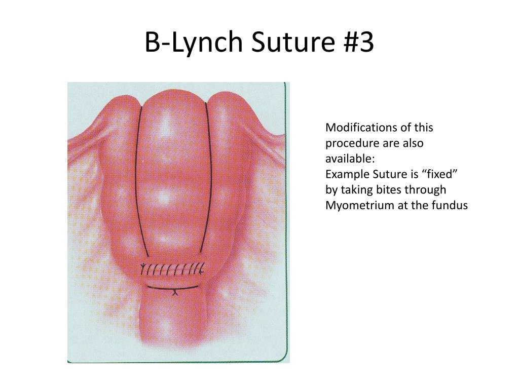 PPT - UPDATE OF NEW TECHNOLOGIES TO TREAT POSTPARTUM HAEMORRHAGE ...