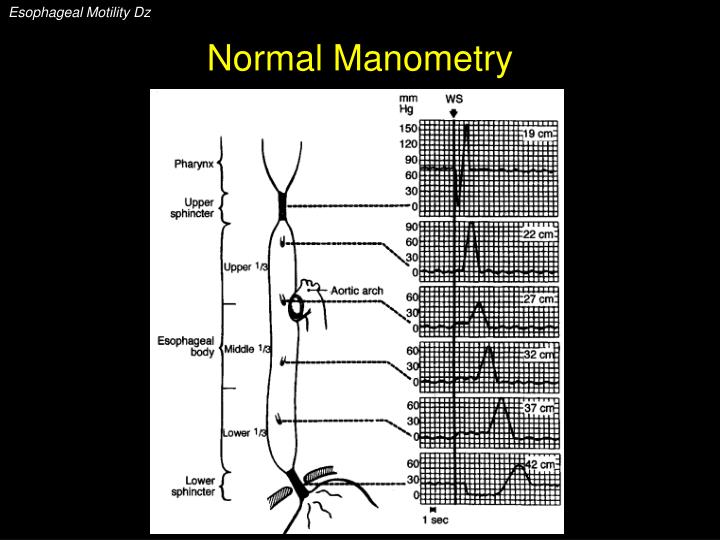 PPT - Esophageal Motility Disorders PowerPoint Presentation - ID:6701046