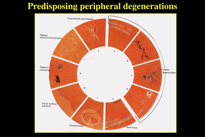 PPT - PATHOGENESIS AND SIGNS OF RETINAL DETACHMENT (RD) PowerPoint ...