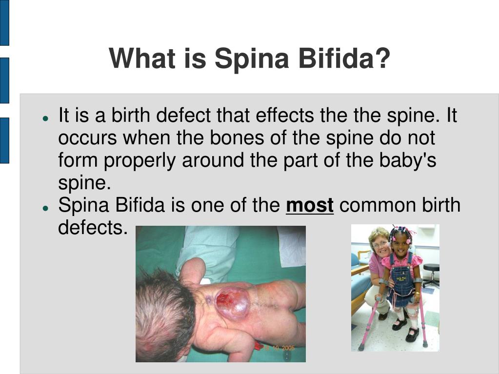 Ppt Spina Bifida Powerpoint Presentation Free Download Id 6713500