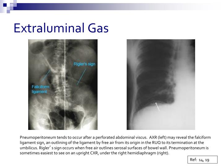 PPT - Reading Abdominal X-rays and Head CTs PowerPoint Presentation ...