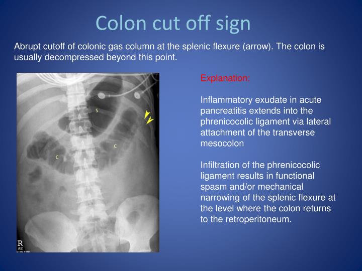 PPT - Abdominal X-ray Radiological Signs PowerPoint Presentation - ID ...