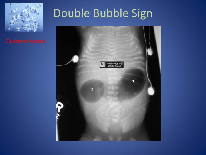 PPT - Abdominal X-ray Radiological Signs PowerPoint Presentation - ID ...