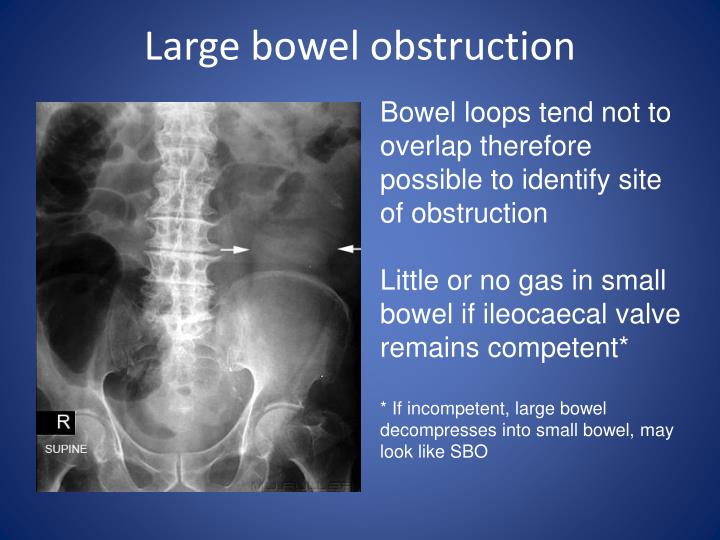 PPT - Abdominal X-ray Radiological Signs PowerPoint Presentation - ID ...