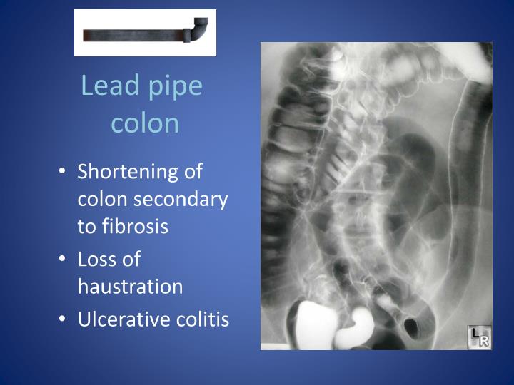 PPT - Abdominal X-ray Radiological Signs PowerPoint Presentation - ID ...