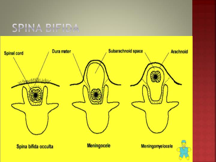 PPT - Neural Tube defects PowerPoint Presentation - ID:6718462