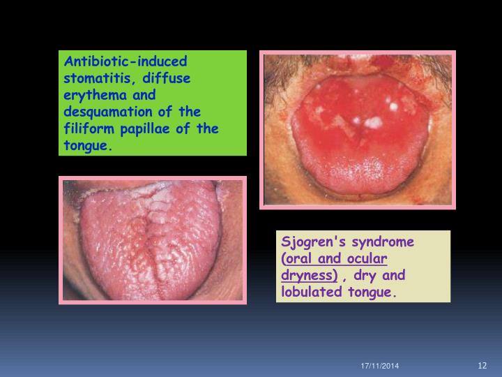 PPT - TOUGUE DISORDERS PowerPoint Presentation - ID:6719147