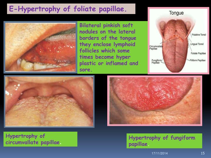 PPT - TOUGUE DISORDERS PowerPoint Presentation - ID:6719147