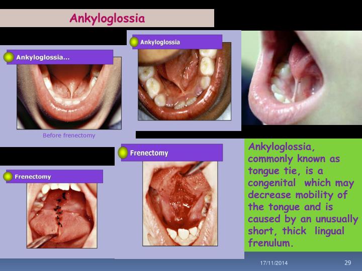 PPT - TOUGUE DISORDERS PowerPoint Presentation - ID:6719147