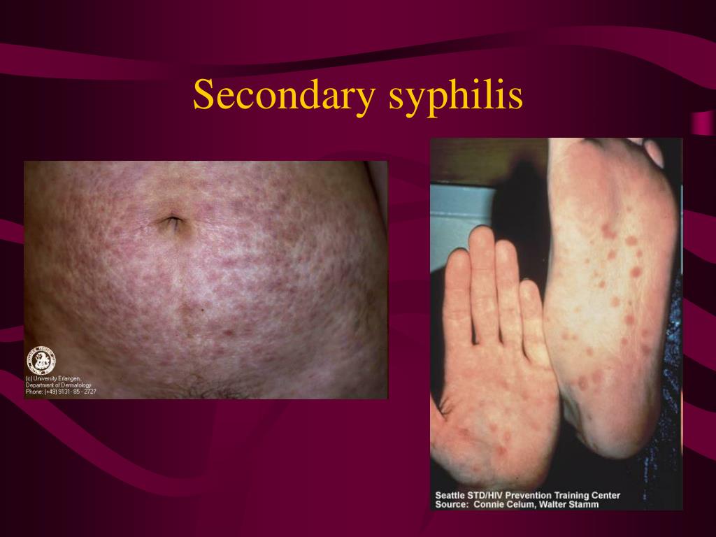 PPT - Infectious Disease Board Review PowerPoint Presentation, free ...