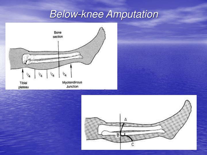 PPT - Indications to Amputations PowerPoint Presentation - ID:6719754
