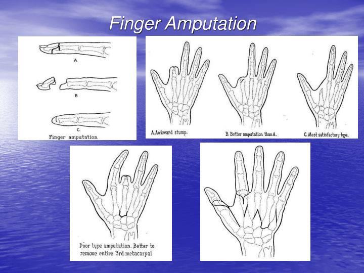 PPT - Indications to Amputations PowerPoint Presentation - ID:6719754