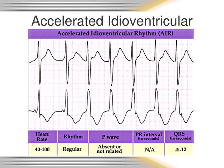 PPT - Rhythm & 12 Lead EKG Review PowerPoint Presentation - ID:6720077