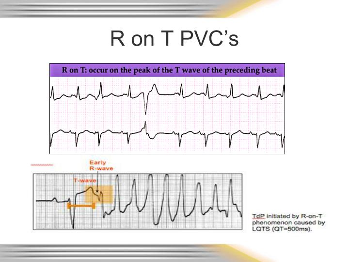 PPT - Rhythm & 12 Lead EKG Review PowerPoint Presentation - ID:6720077