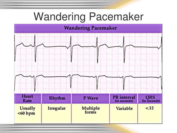 PPT - Rhythm & 12 Lead EKG Review PowerPoint Presentation - ID:6720077