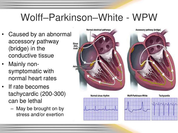 PPT - Rhythm & 12 Lead EKG Review PowerPoint Presentation - ID:6720077